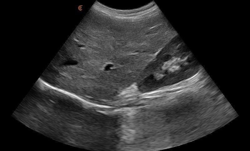 Clinical Gallery - Portable Pocket Handheld Ultrasound Scanner - Clarius