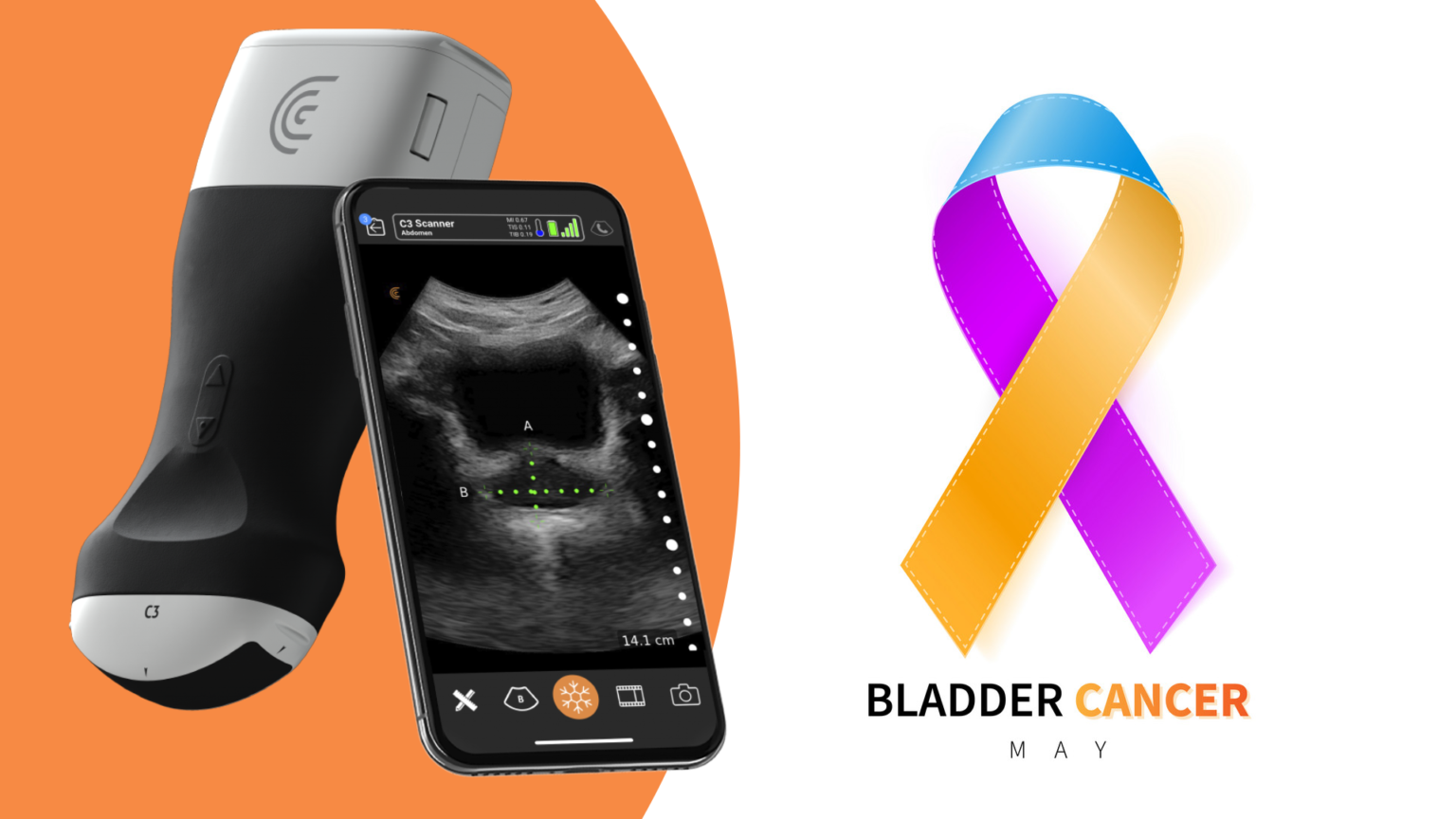 Ultrasound and Bladder Cancer - Clarius Mobile Health
