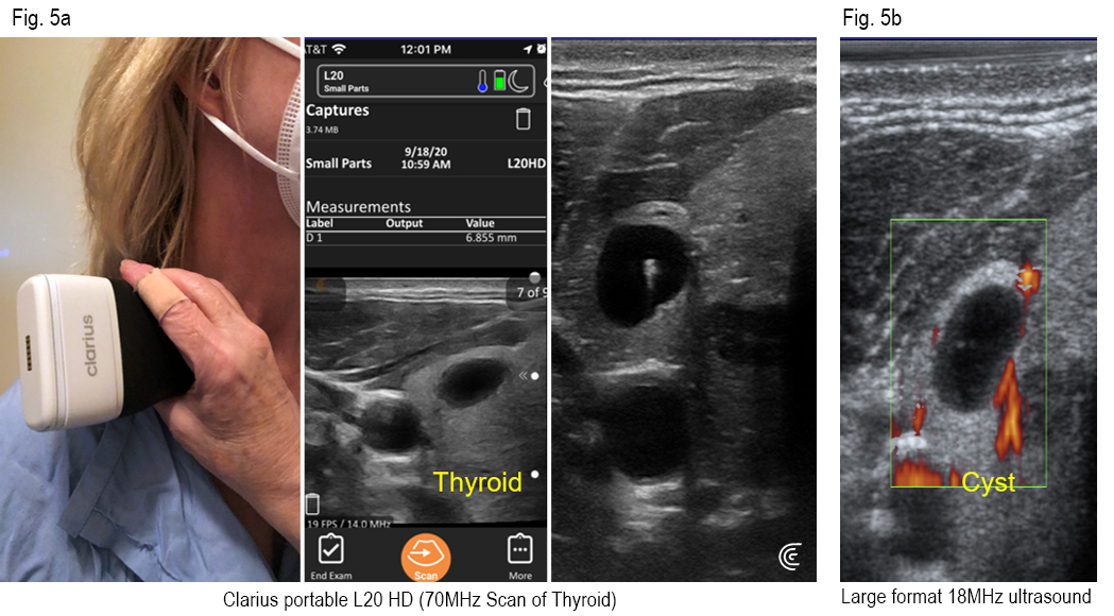 Point-of-Care Ultrasound Review of the Clarius L20 HD by Dr. Bard ...
