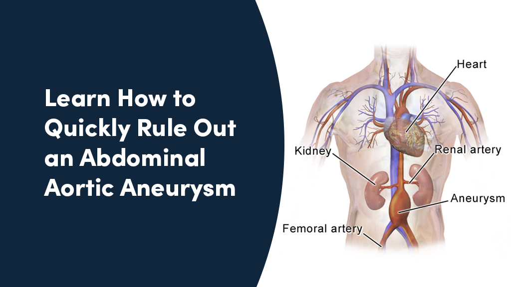 [VIDEO] Learn How to Quickly Rule Out an Abdominal Aortic Aneurysm - Clarius Mobile Health