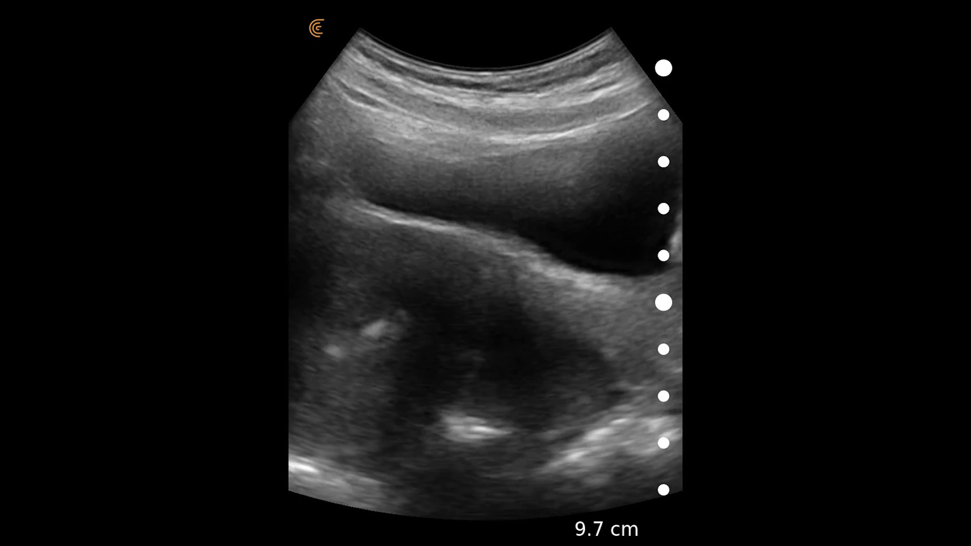 IUD Sagittal - Clarius Mobile Health