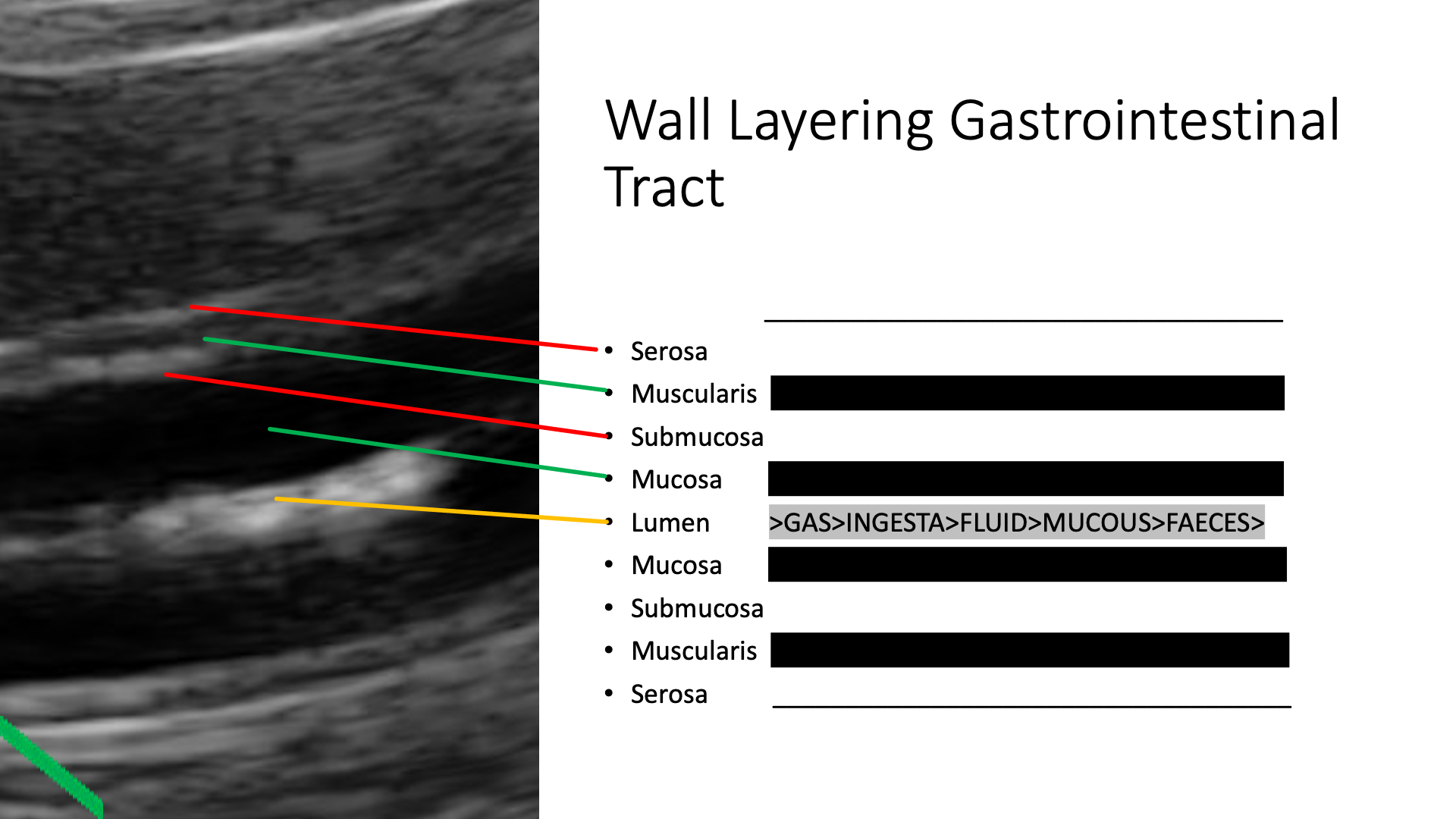 [VIDEO] Learn How to Use Ultrasound to Look for Intestinal Pathology in ...