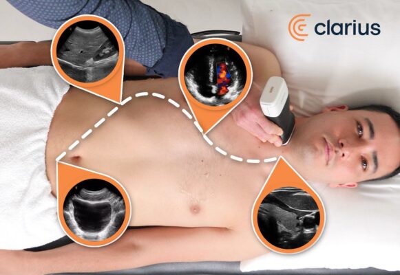 Clarius Introduces First Ultrasound System That Uses AI and Machine ...