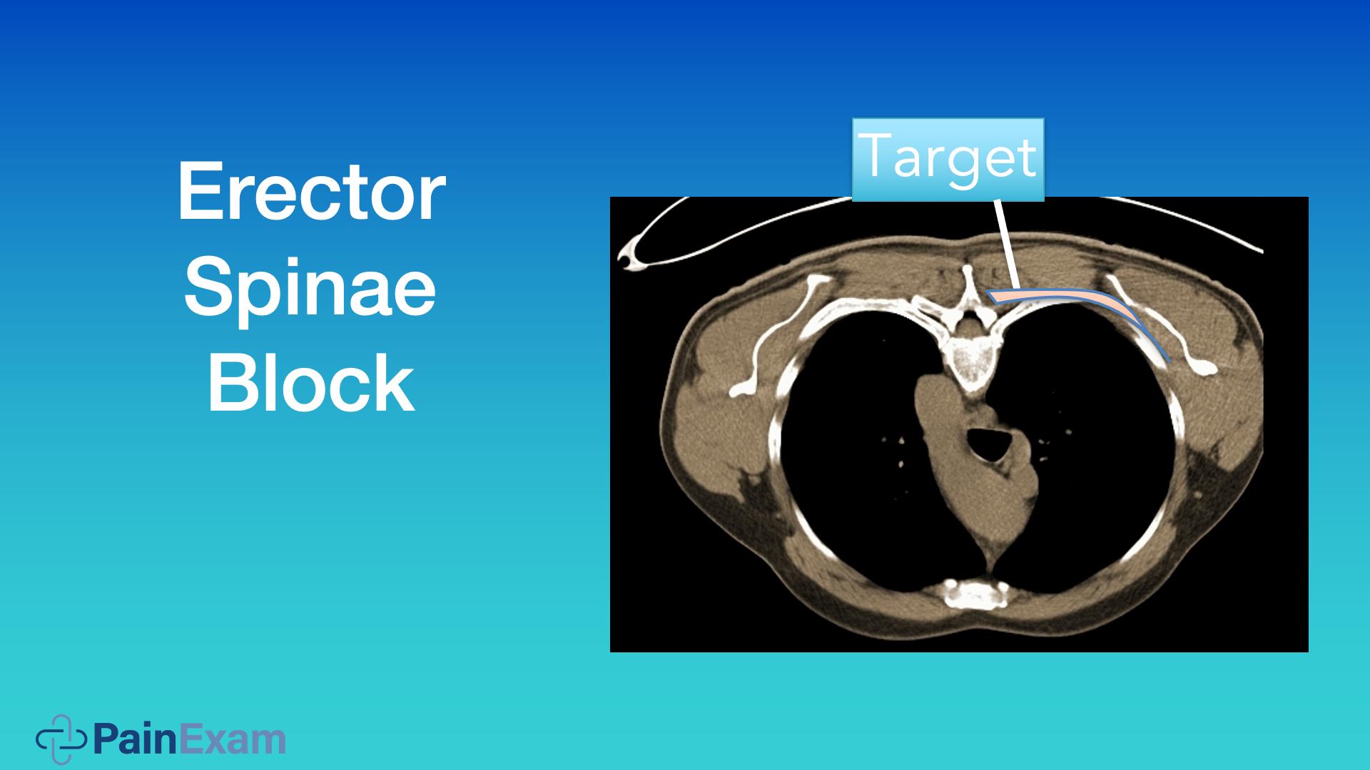 [VIDEO] Ultrasound-Guided Pain Injections: Treating Severe Chronic Neck ...