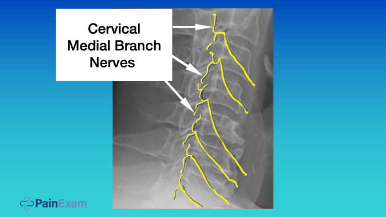 Pain Management Case Study: Treating Severe Chronic Neck Pain and Headache with an Occipital ...