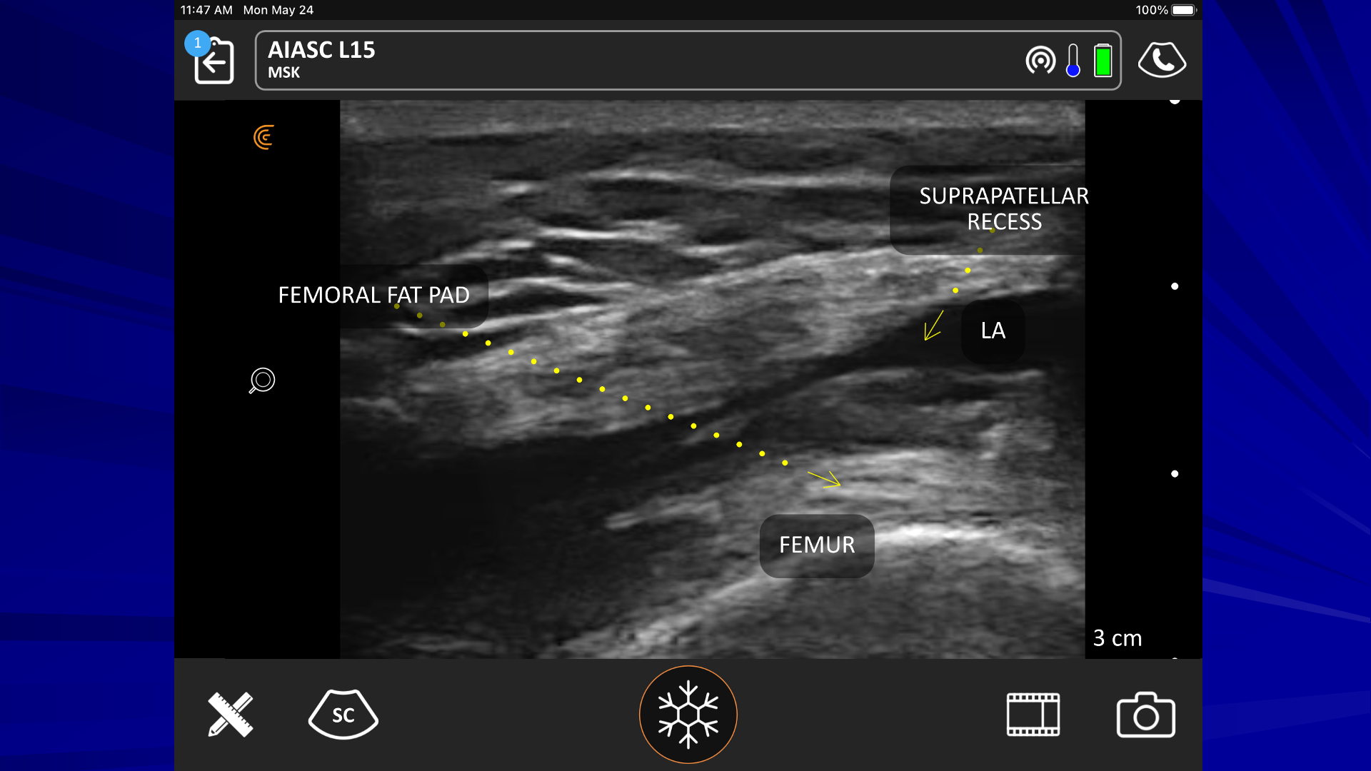 [VIDEO] Using Ultrasound to Guide Intra-Articular Injections of the ...