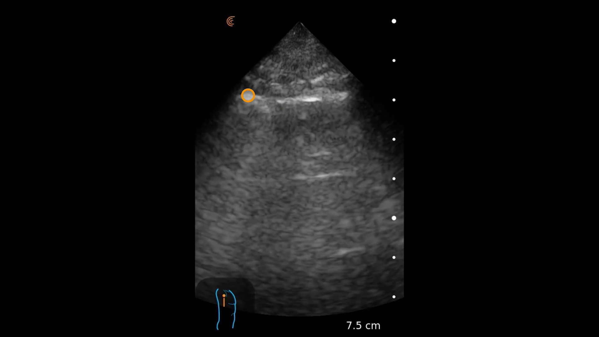 Skip Lesions / Patchy Infiltrate - Clarius Mobile Health