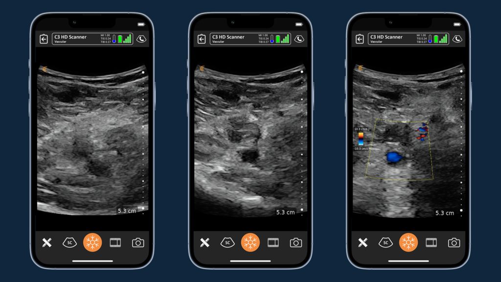 Ultrasound and Bladder Cancer | Clarius