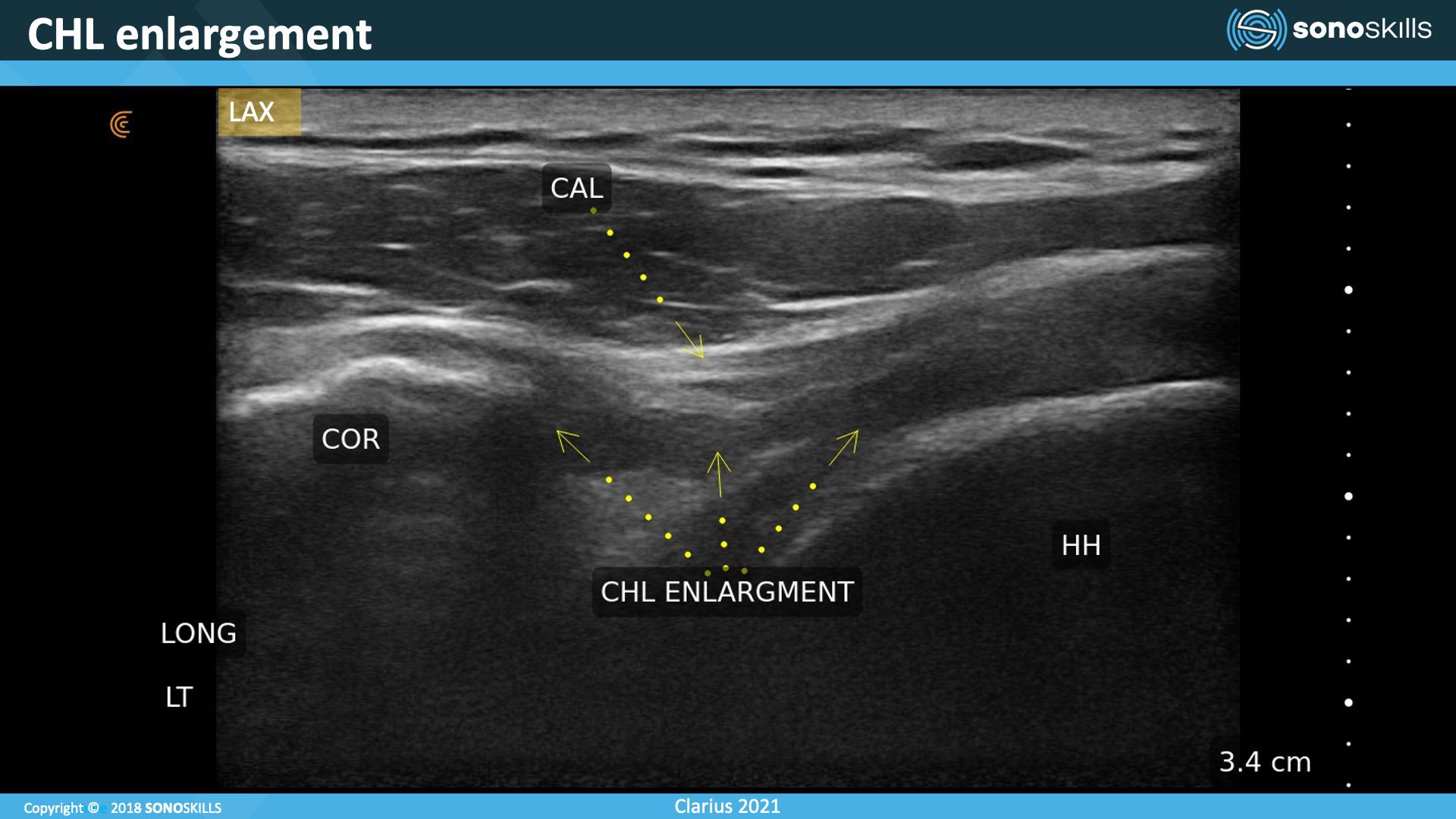 Learn to Scan the Rotator Interval and Identify Pathology | Clarius