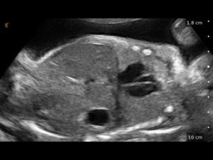 Clarius HD Ultra-portable Ultrasound