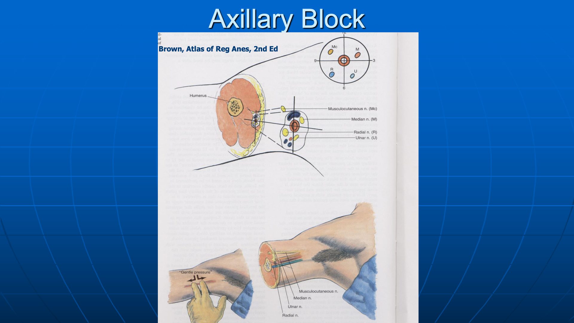 Learn How to Perform Ultrasound-Guided Brachial Plexus Blocks | Clarius ...