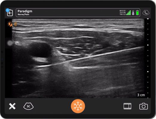Expert Ultrasound-Guided Blocks for Knee Surgery – IPACK, Genicular ...