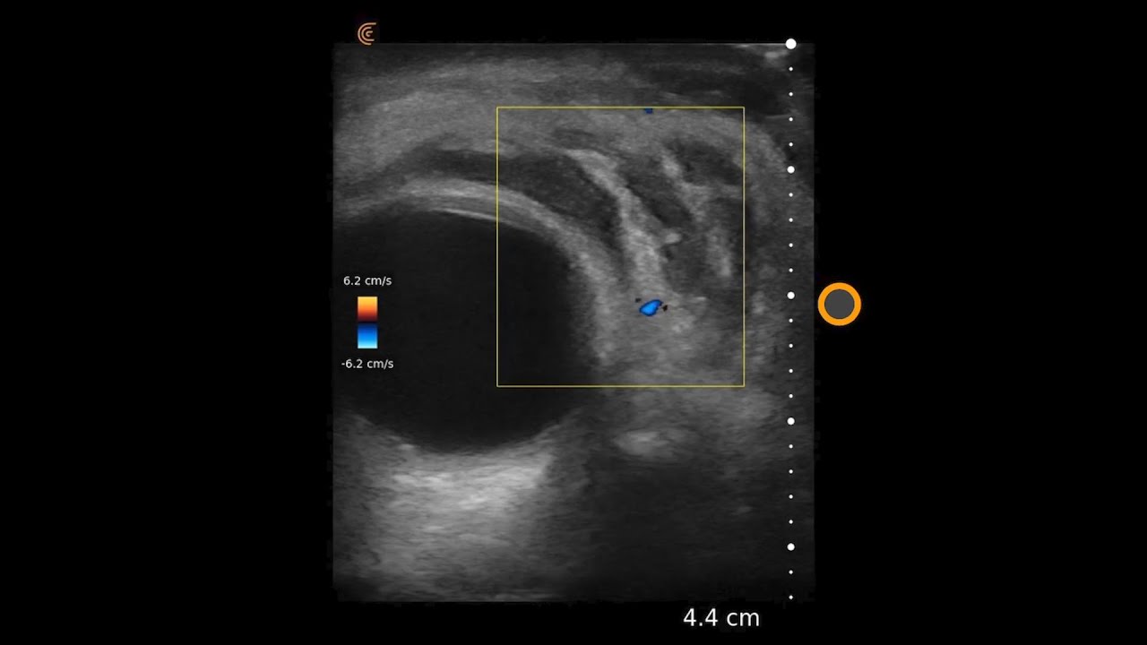 Posterior Shoulder Dislocation | Clarius