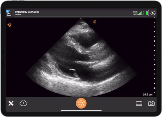 Cardiac POCUS Part 1: Techniques for Assessing Left Ventricular Function | Clarius