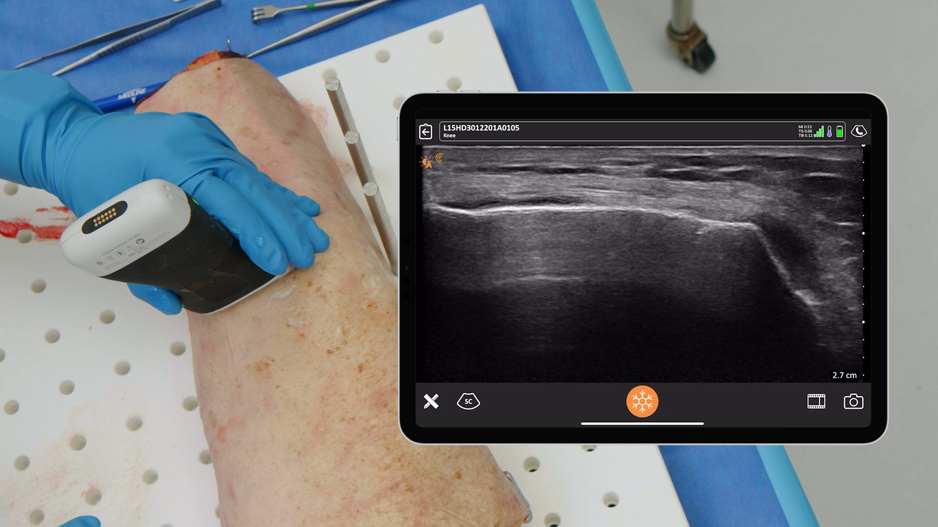 Identify MPFL Anchor Location | Clarius