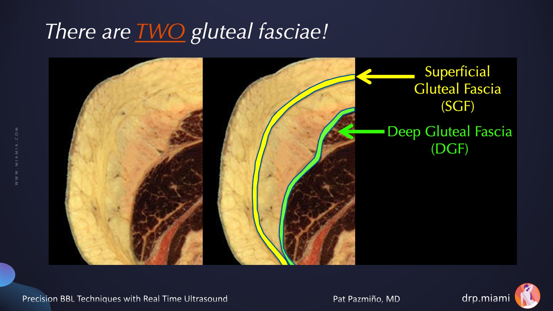 Learn How to Perform the UltraBBL: Brazilian Butt Lift Using Real-Time ...