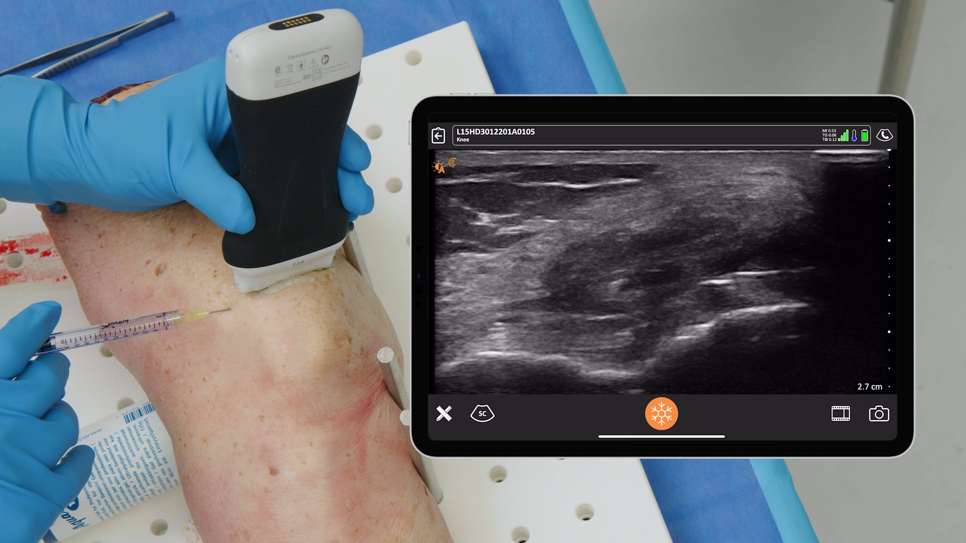 Suprapatellar Intra-articular Injection | Clarius