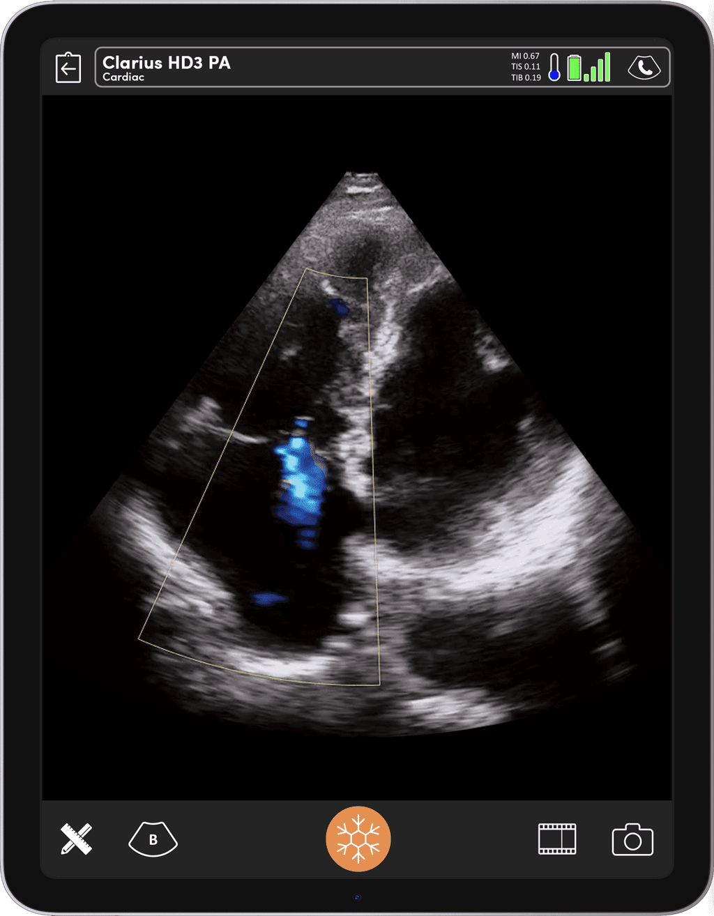 Cardiac POCUS Part 2: Techniques for Assessing Right Ventricular ...