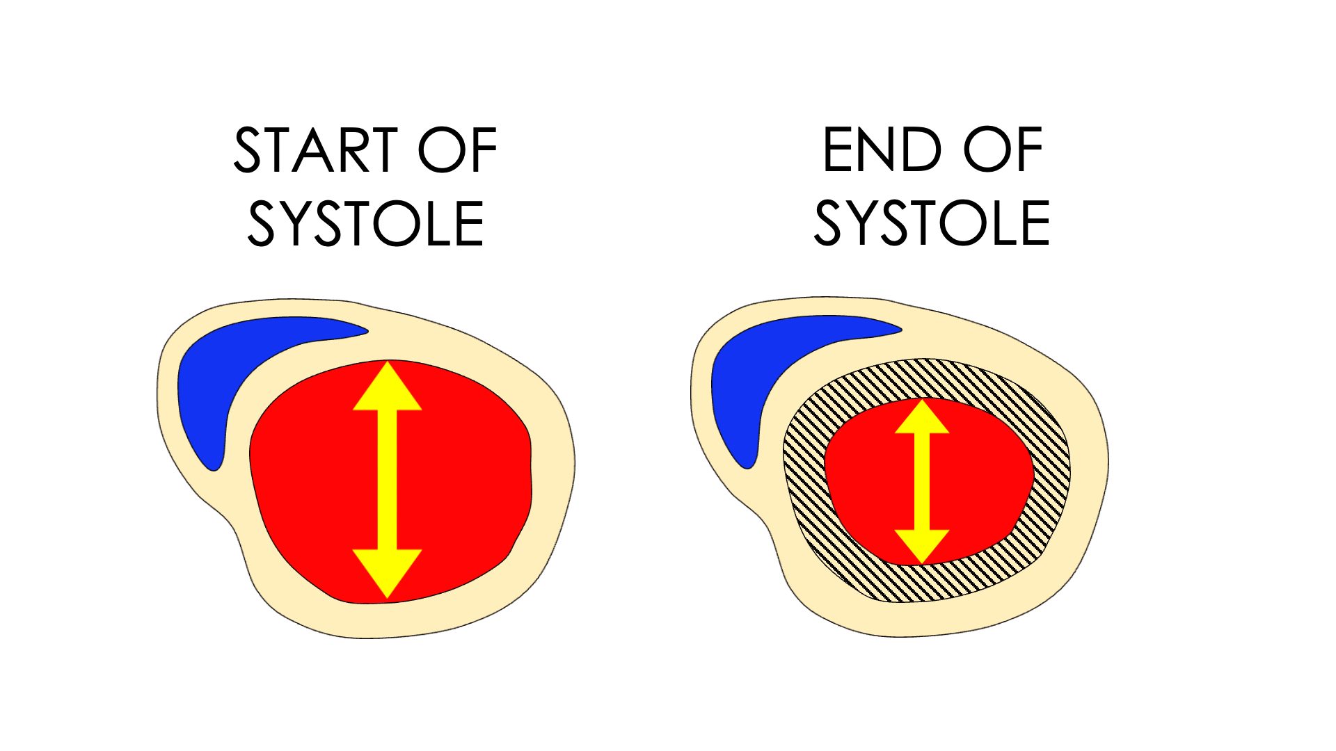 Use POCUS to Assess Left Ventricular Function in 30 seconds | Clarius