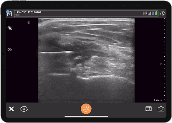 Ultrasound for Sports Medicine: Guiding Safe, Accurate PRP Injections ...
