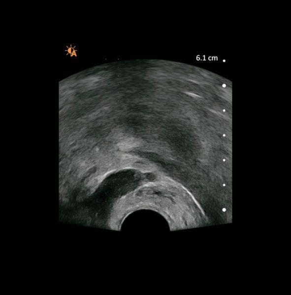 Transrectal Periprostatic Block | Clarius