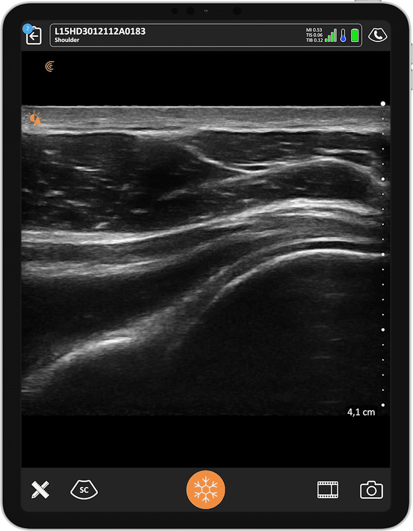 Pragmatic MSK Ultrasound: Dynamic Assessment of the Shoulder | Clarius