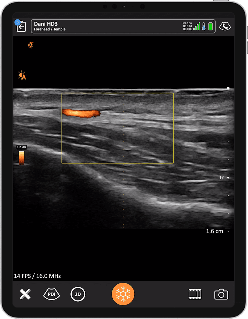 Facial Filler Safety 101: Ultrasound Mapping for Accurate Aesthetic ...
