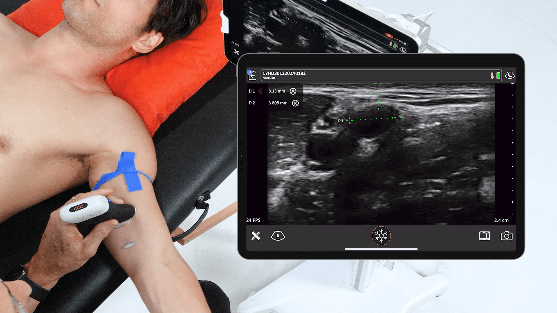 Vein Identification for Line Placement | Clarius