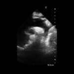 Phased Array + Linear Array | Clarius