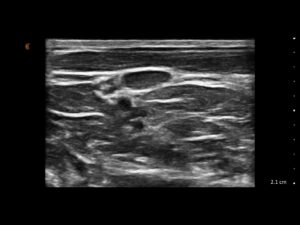 Phased Array + Linear Array | Clarius