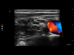 Supraclav Brachial Plexus | Clarius