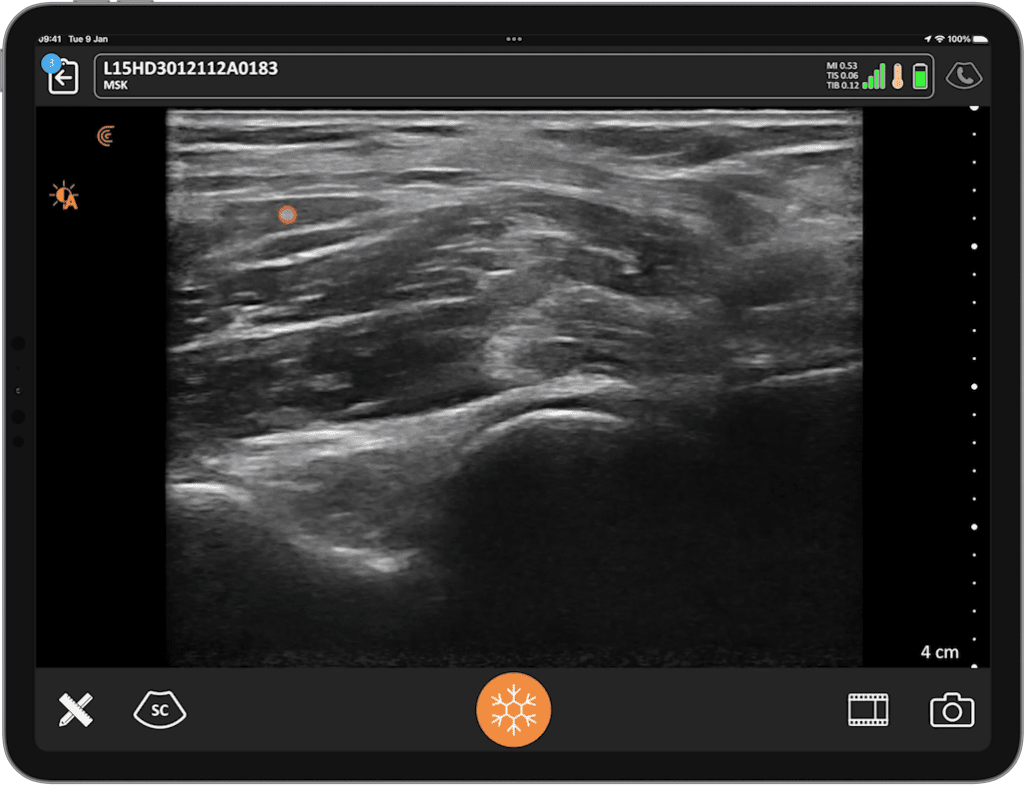 Pragmatic MSK Ultrasound: 8-Step Protocol for Assessing the Distal Biceps Tendon | Clarius