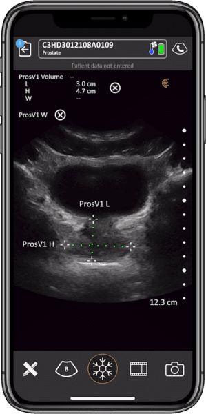 POCUS in Urology: 5 Ways to Streamline Patient Care | Clarius