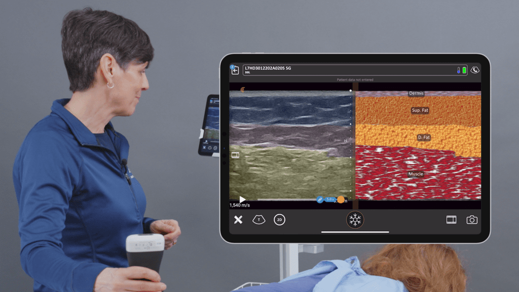 Ultrasound-Guided Fat Grafting: Safe Techniques for BBL and Breast ...