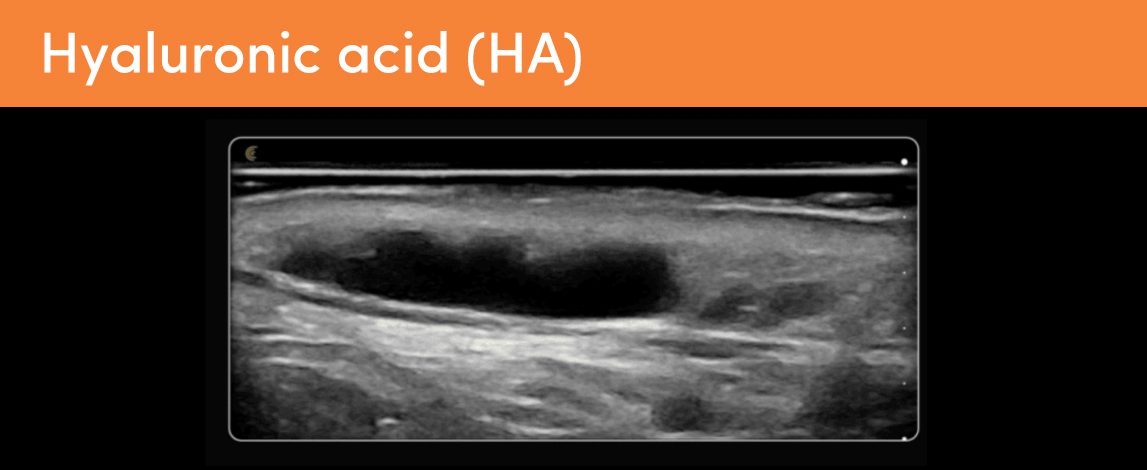 Guided Treatment for Managing Permanent Facial Filler Complications ...