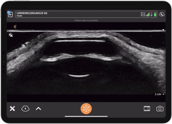 Ocular POCUS: Diagnosing Traumatic Eye Injuries and Avoiding Vision ...