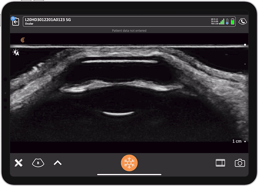 Ocular POCUS: Diagnosing Traumatic Eye Injuries and Avoiding Vision ...