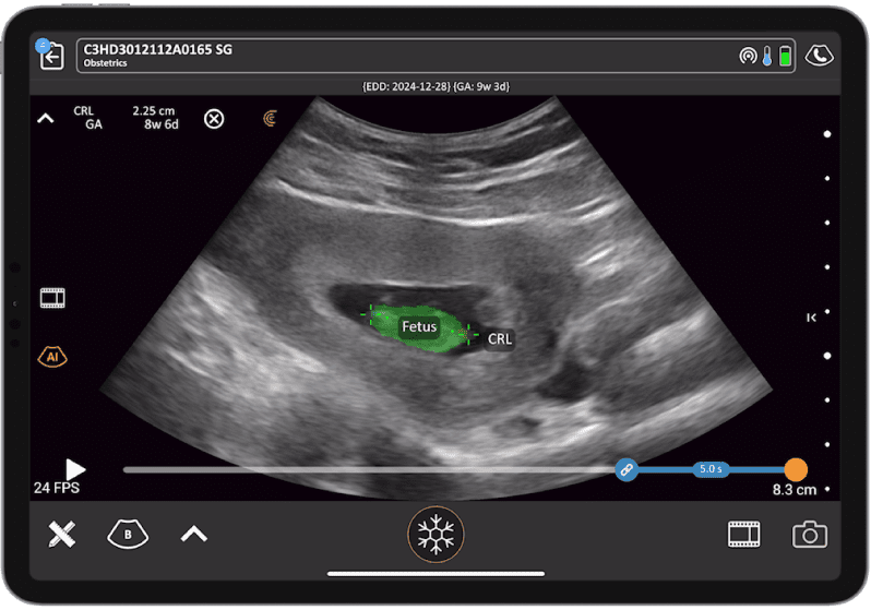 Early Pregnancy Care: 1st Trimester Ultrasound Essentials for Midwives ...