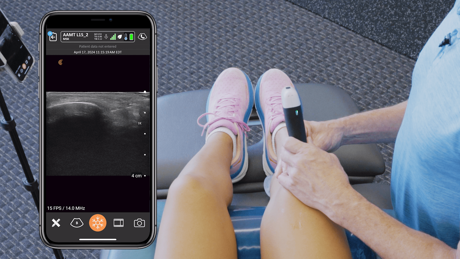 USG Dry Needling Patellar Tendon | Clarius