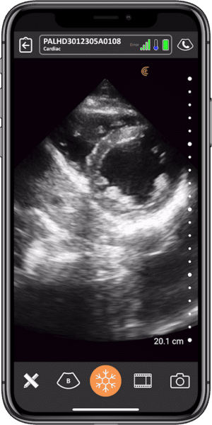 Cardiac POCUS: Coronary Artery Disease for the Non-Cardiologist | Clarius
