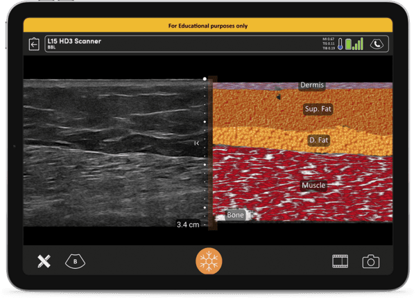 T-Mode | Learn Ultrasound the Easy Way