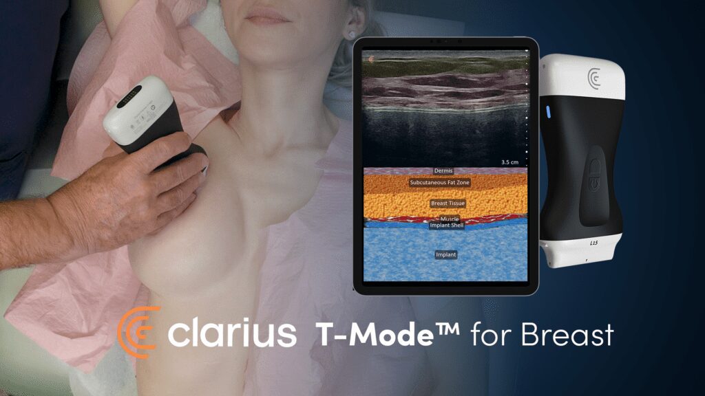 Clarius AI-Powered Ultrasound Now Enables Plastic Surgeons to Quickly Master Ultrasound Breast ...