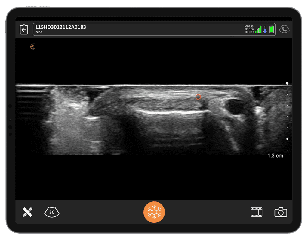 POCUS for MSK: Mastering Hand and Wrist Ultrasound | Clarius