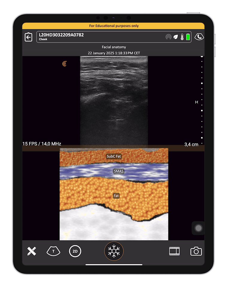 Facial Ultrasound Anatomy: Evaluating Skin Layers, SLEB for Dermal ...