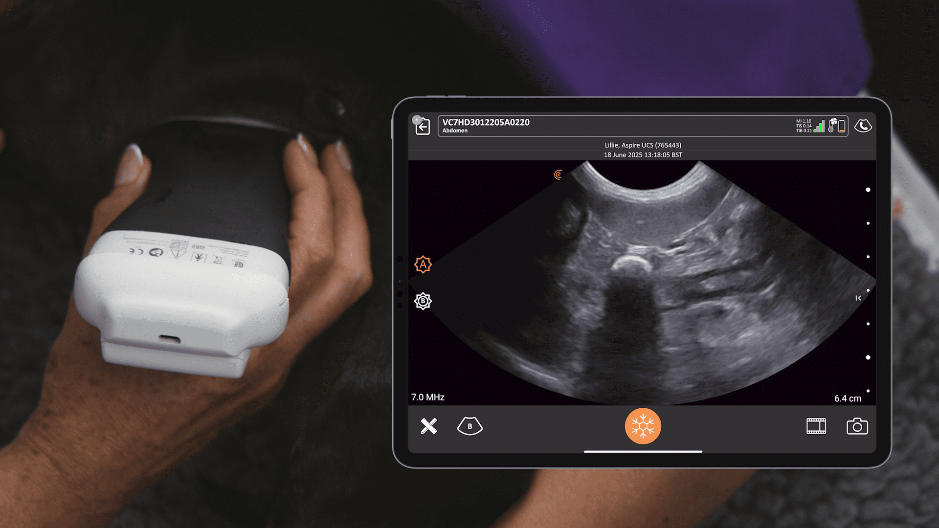 The Aspire UCS 8 Step Abdominal Survey Step 3: Diaphragm, Spleen, and Splenic Vein | Clarius